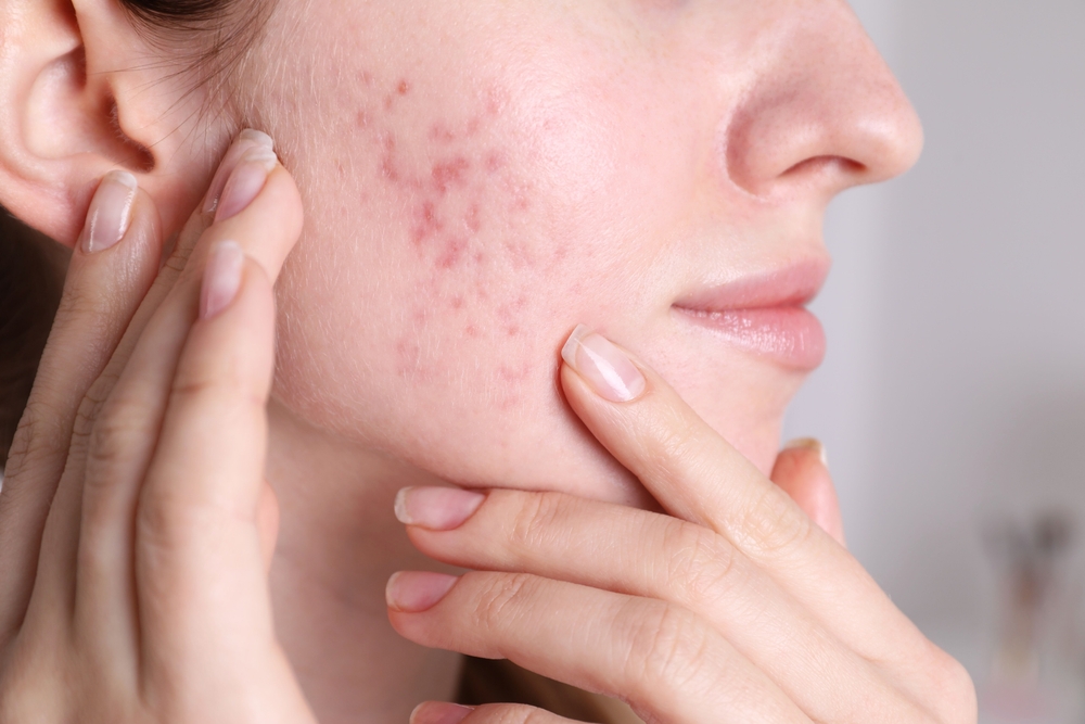 Acné hormonale : comprendre et traiter sans agresser votre peau ...
